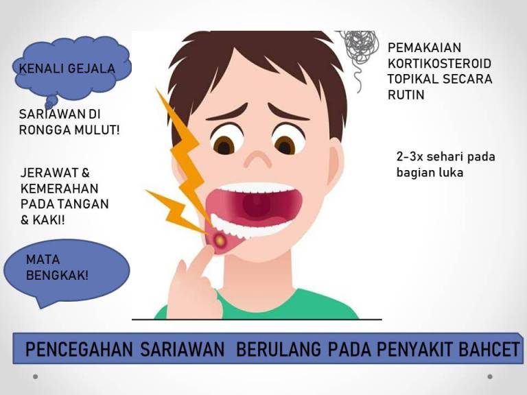 Tips Mengatasi Sariawan Berulang Pada Penderita Penyakit Behcet ...